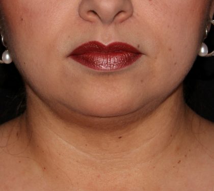 Patient #1385 Chin Before and After Photos Houston, Texas ...
