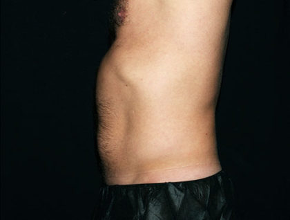 Patient #1693 Flank / Side Before and After Photos Houston, Texas ...