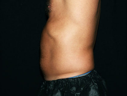 Patient #1693 Flank / Side Before and After Photos Houston, Texas ...