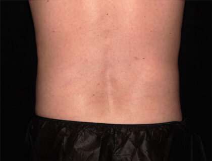 Patient #1927 Flank / Side Before and After Photos Houston, Texas ...