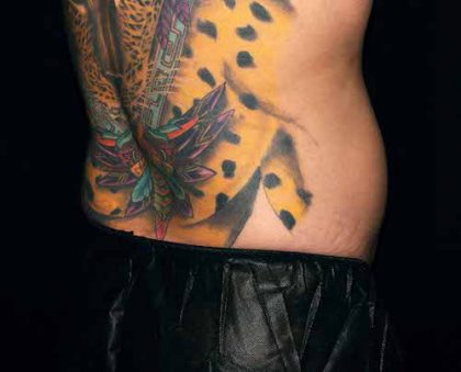 Patient #2016 Flank / Side Before and After Photos Houston, Texas ...