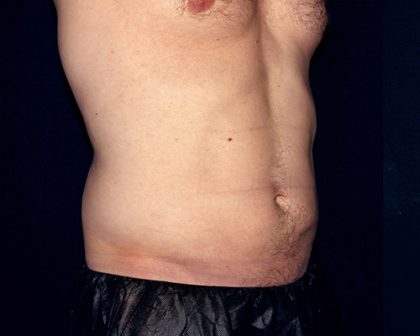 Patient #2056 Flank / Side Before and After Photos Houston, Texas ...