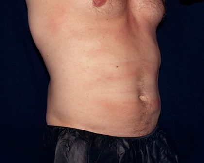 Patient #2056 Flank / Side Before and After Photos Houston, Texas ...