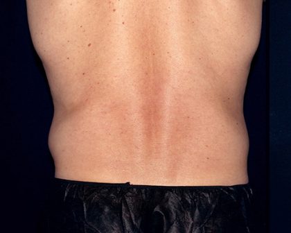 Patient #2056 Flank / Side Before and After Photos Houston, Texas ...